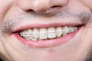 Mengenal Perbedaan Behel Metal dan Behel Transparan